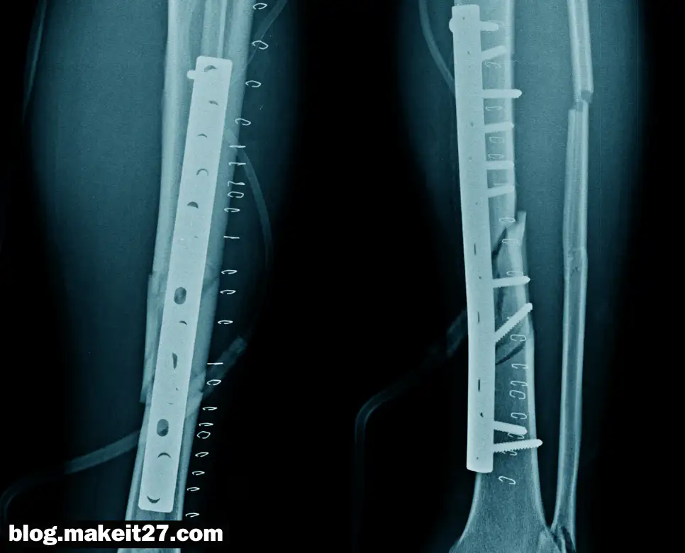 의학용어 OM, ORIF, NPH - 블로그잇27